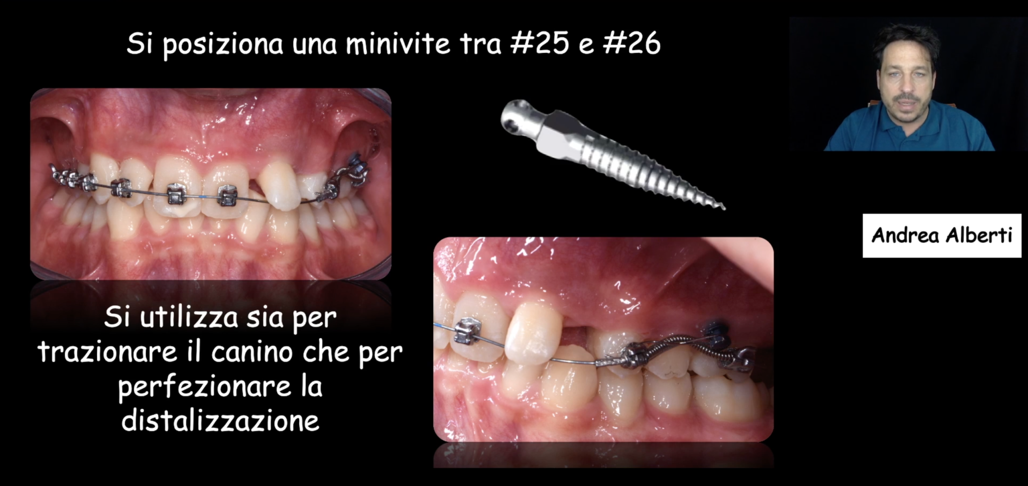 GESTIONE RAGIONATA DEL CANINO INCLUSO VESTIBOLARE - Orthomand