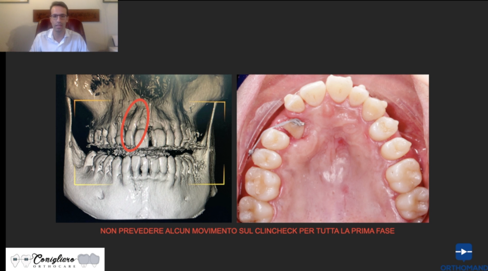 CANINI INCLUSI E INVISALIGN: QUALI LIMITI? - Orthomand