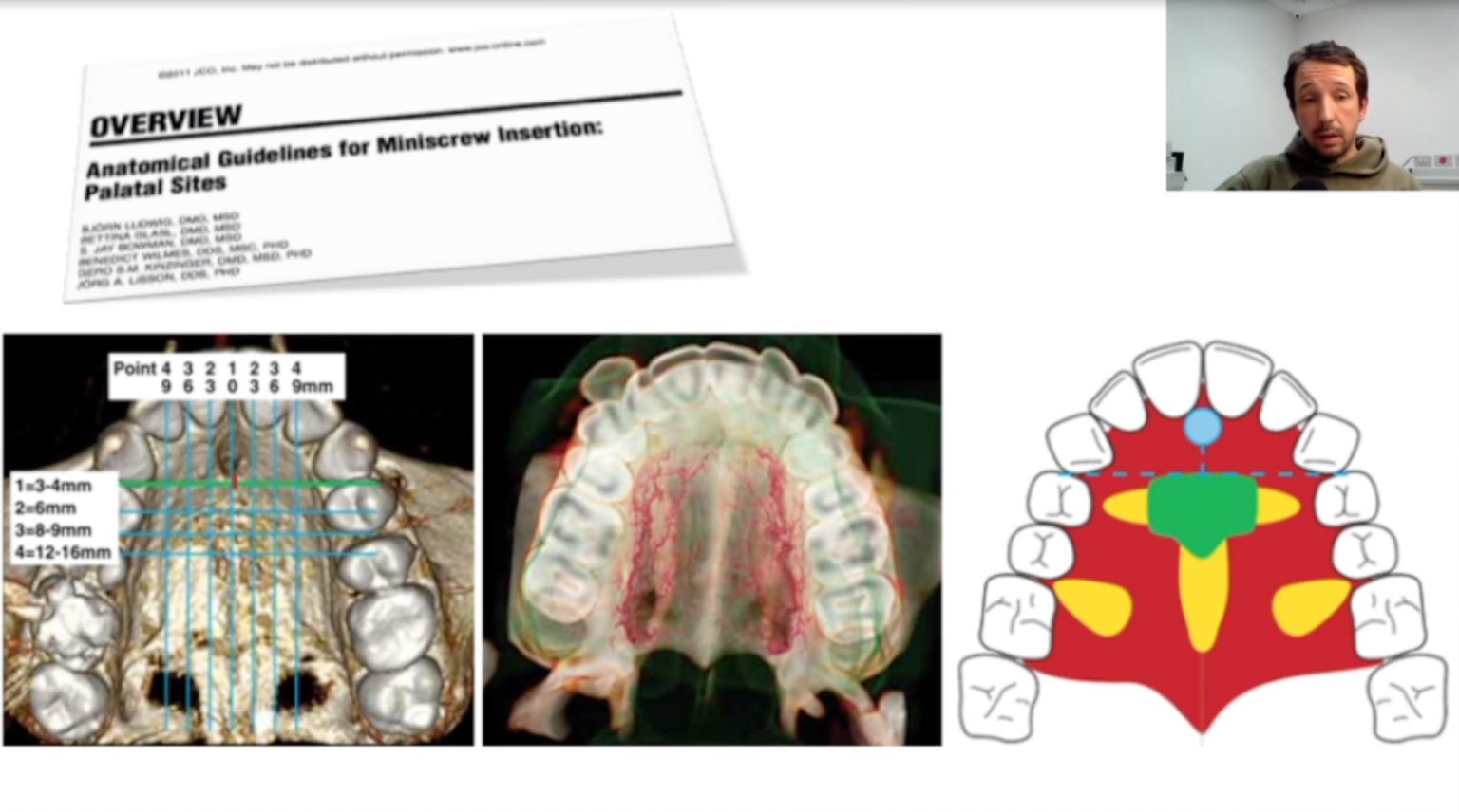 ANCORAGGIO PALATALE: PROTOCOLLI DI INSERZIONE - Orthomand