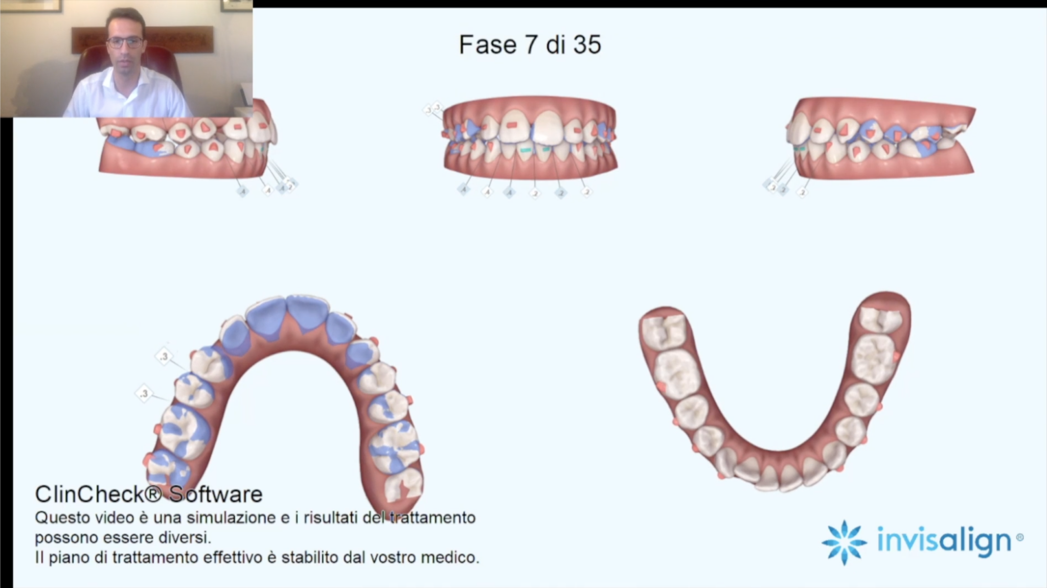 CANINI INCLUSI E INVISALIGN: QUALI LIMITI? - Orthomand