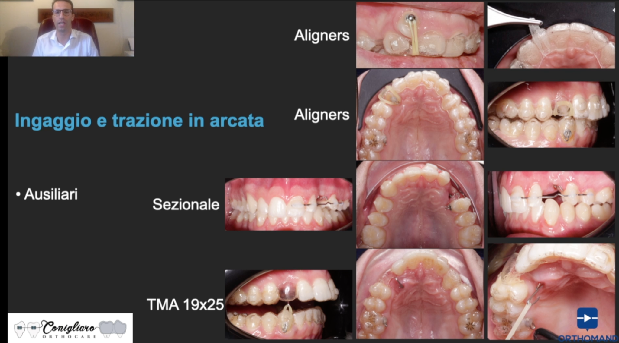 CANINI INCLUSI E INVISALIGN: QUALI LIMITI? - Orthomand