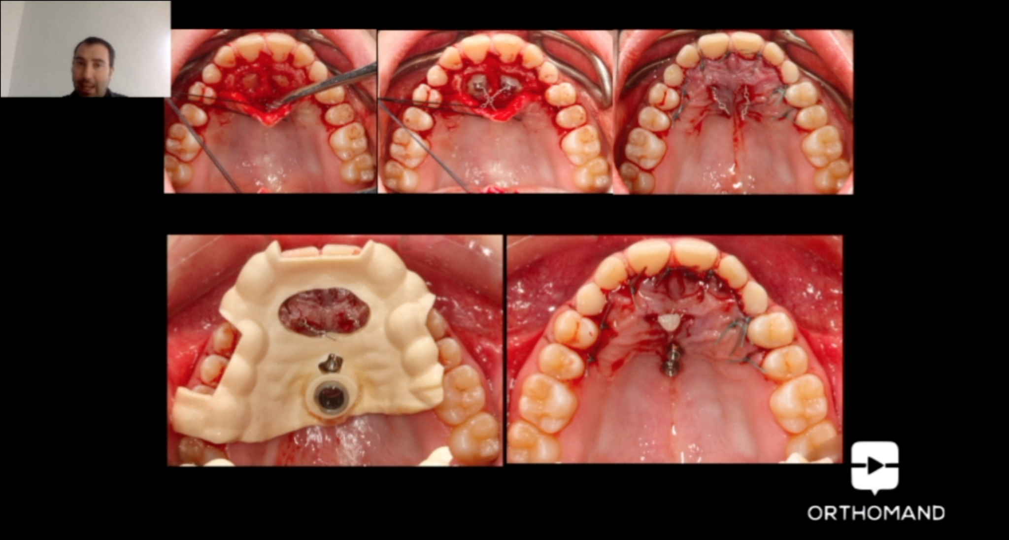 LA DISINCLUSIONE DEL CANINO PALATALE NELL’ERA DIGITALE - Orthomand
