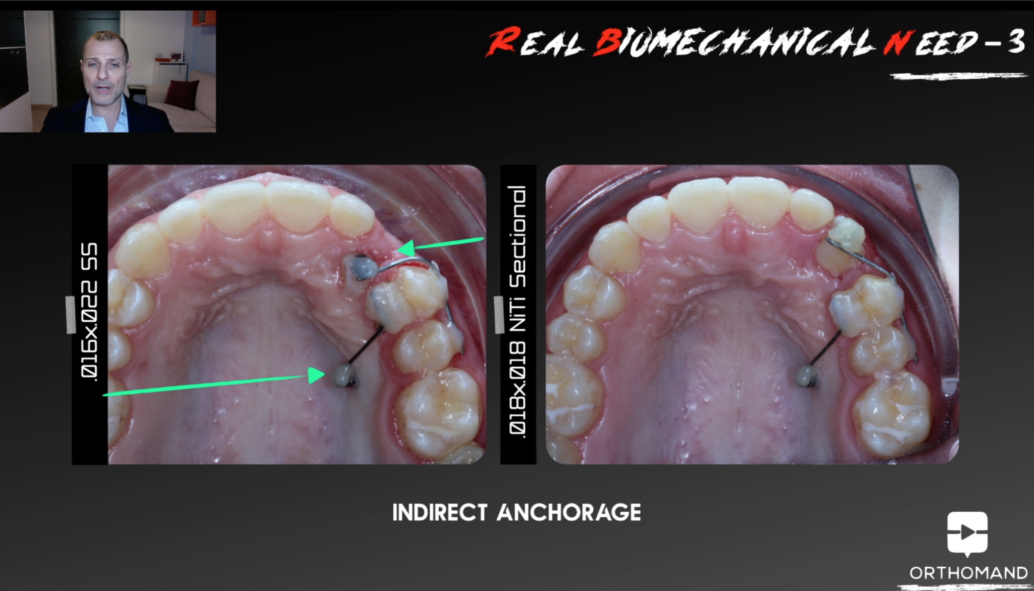 MINIVITI E INVISALIGN Vol 3: le tads "game changer" - Orthomand