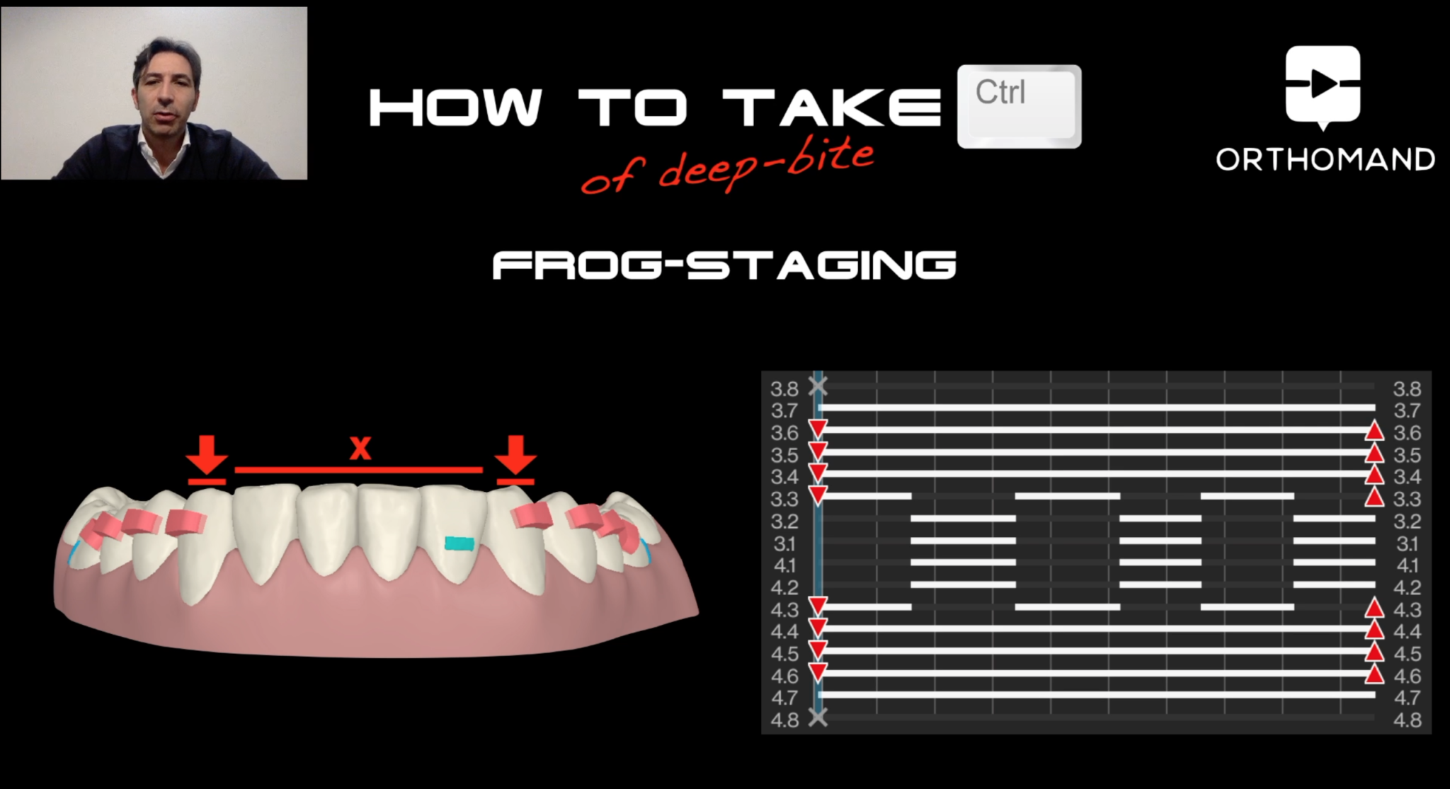 DEEP BITE E INVISALIGN: i miei protocolli per un trattamento del morso ...