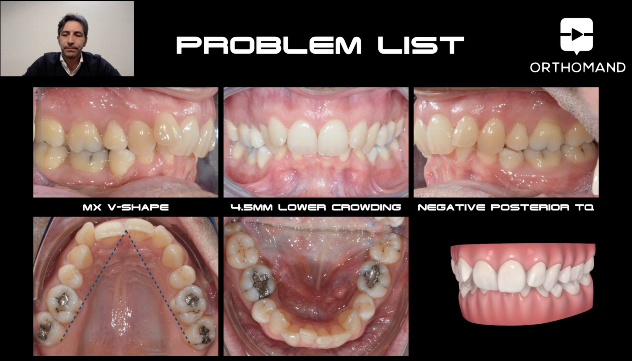 DEEP BITE E INVISALIGN: i miei protocolli per un trattamento del morso ...