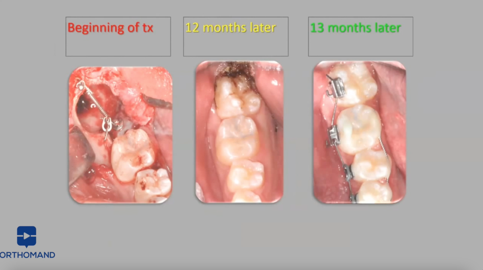 MOLARI MANDIBOLARI: DISINCLUSIONE ED UPRIGHTING - Orthomand
